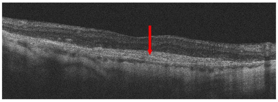 Summary of the Therapeutic Options for Patients with Dry and ...