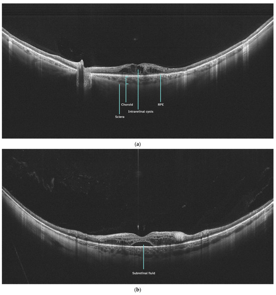 Wide-Field Optical Coherence Tomography in Patients with Diabetic ...