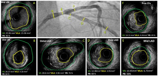 Beyond Stress Ischemia: Unveiling the Multifaceted Nature of Coronary ...