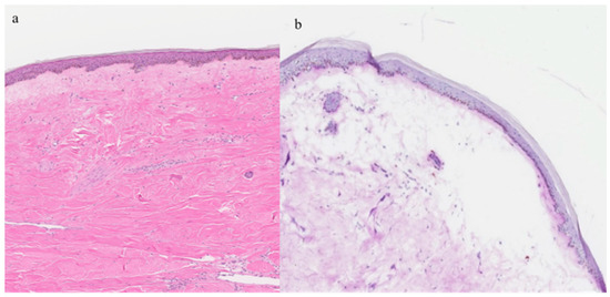 A Rare Case of Bullous Morphea Associated with Autoimmune Hepatitis