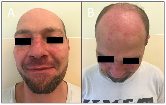 JCM | Free Full-Text | Psoriasis and Lupus Erythematosus—Similarities ...