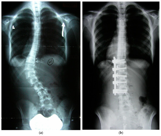Anterior Spinal Fusion for Thoraco-Lumbar Idiopathic Scoliosis ...