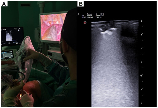 Ultrasound for Intra-Operative Detection of Peri-Centimetric Pulmonary ...