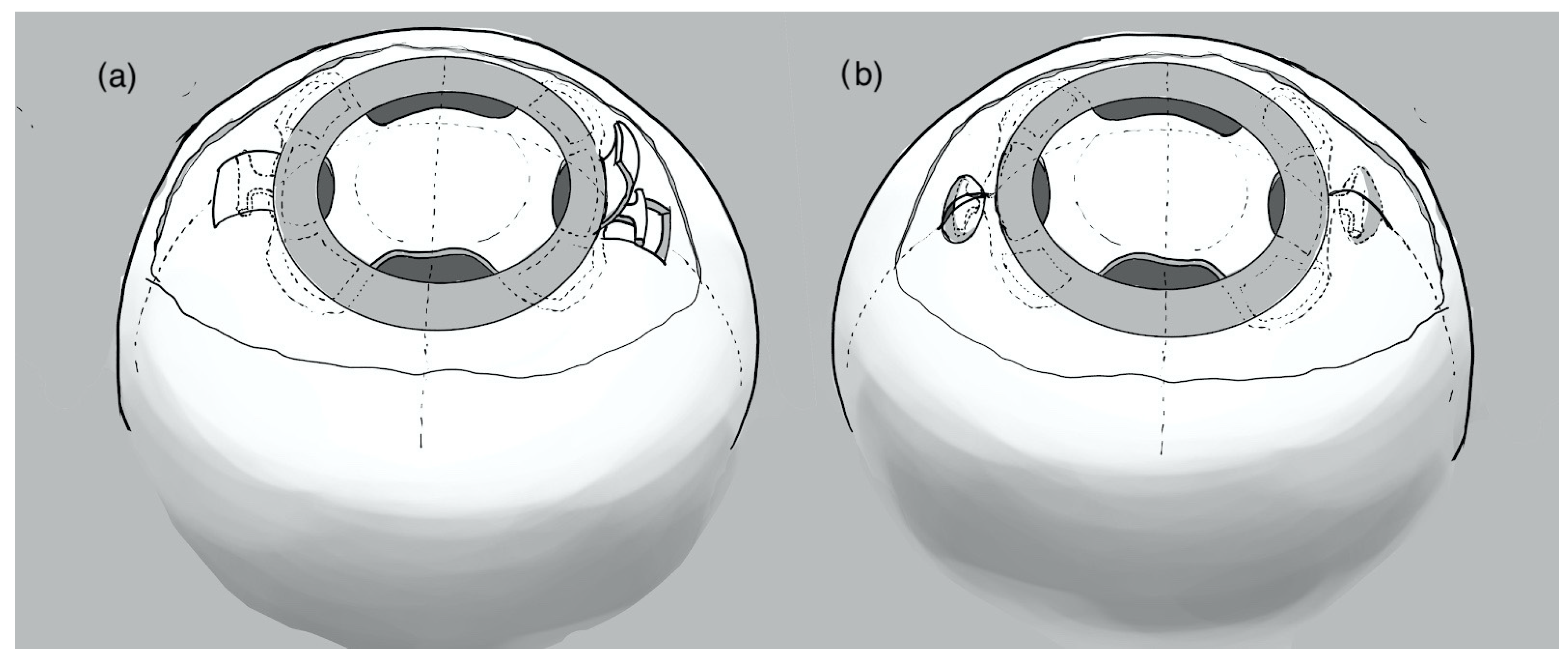 Long-Term Surgical Outcomes of Scleral Flap versus Scleral Pocket ...