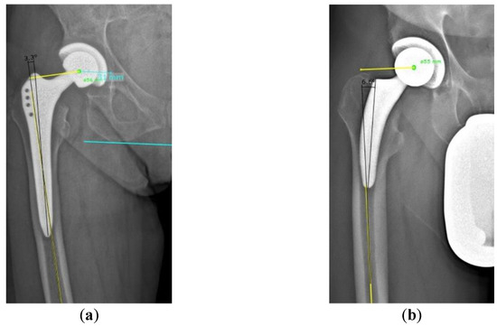 Effect of Stem Design and Positioning on the Leg Axis after Total Hip ...