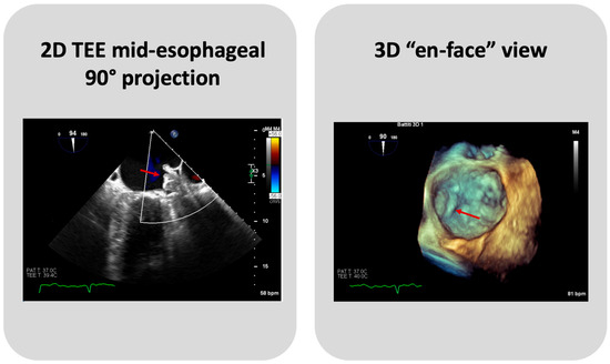Watchman vs. Amulet for Left Atrial Appendage Closure: Current Evidence ...