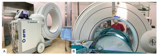 The Impact of Navigation in Lumbar Spine Surgery: A Study of Historical ...