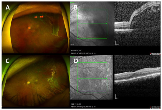 JCM | Free Full-Text | Rhegmatogenous Retinal Detachment with Giant ...