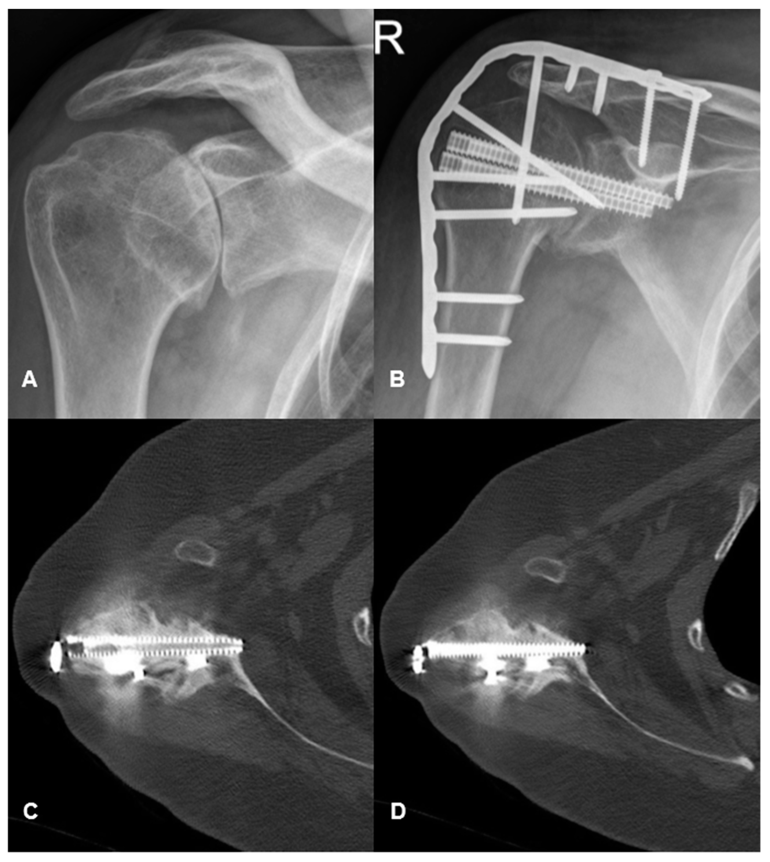 JCM | Free Full-Text | Clinical and Surgical Outcomes of Shoulder ...