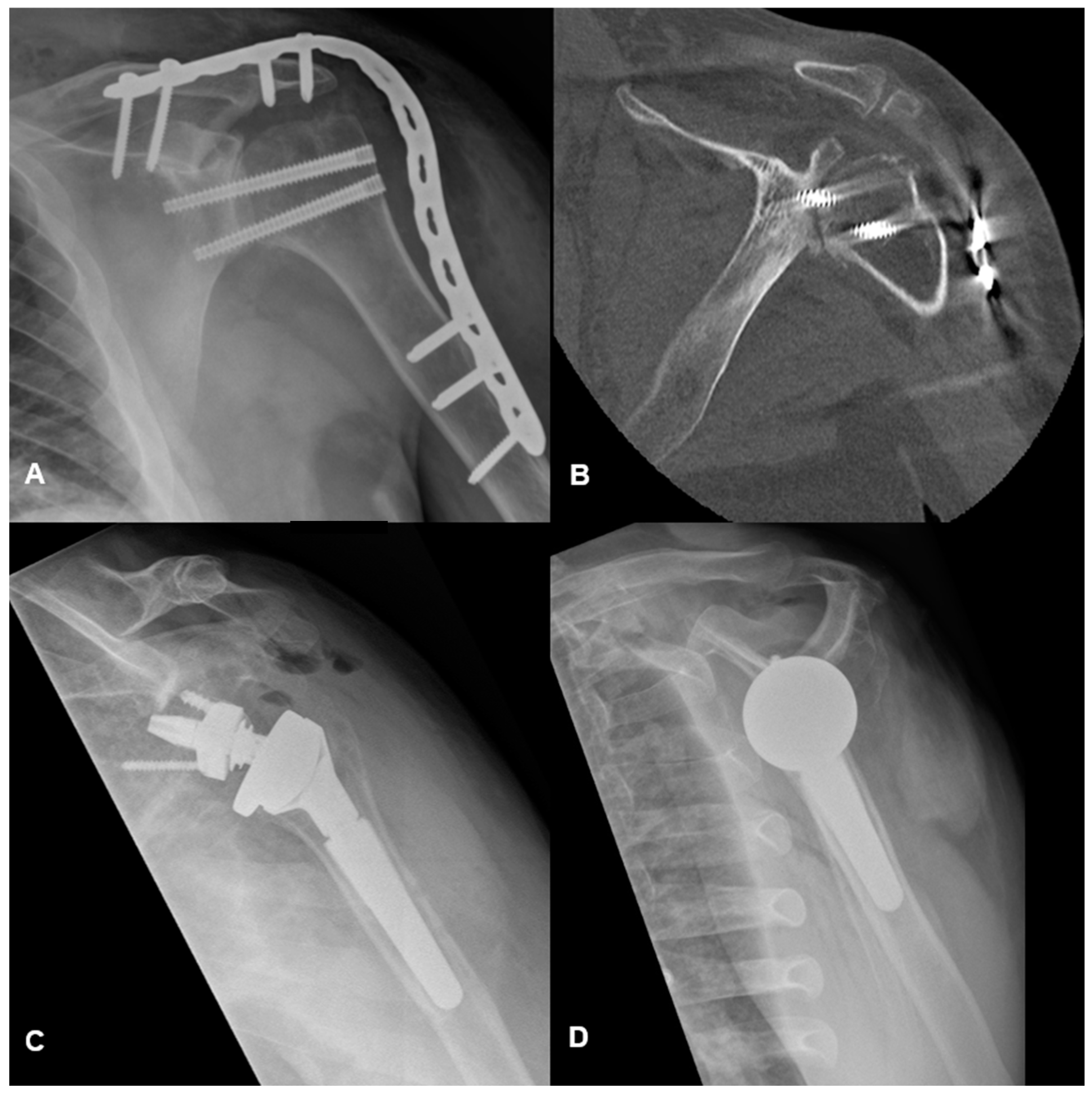 JCM | Free Full-Text | Clinical and Surgical Outcomes of Shoulder ...