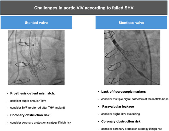 Aortic Valve-in-Valve Procedures: Challenges and Future Directions