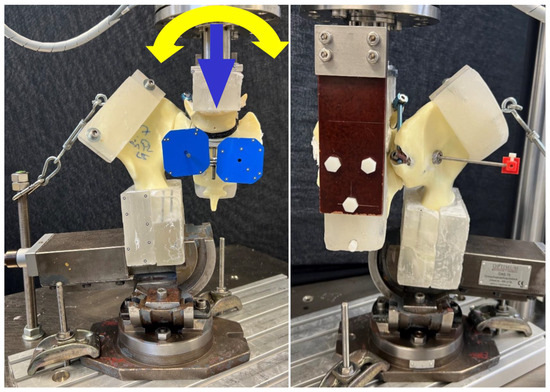 Lumbopelvic Stabilization with Two Methods of Triangular Osteosynthesis ...