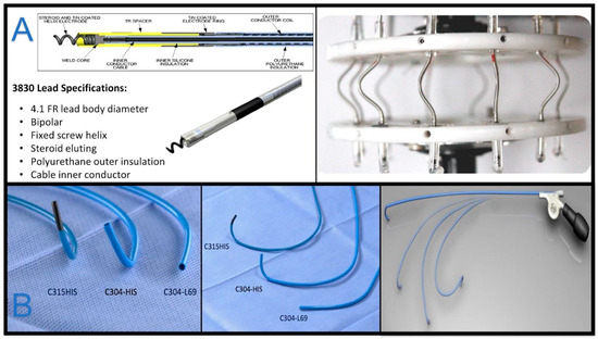 Lumenless and Stylet-Driven Leads for Left Bundle Branch Area Pacing ...