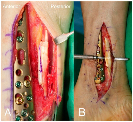 Joint Preservation Surgery Using Supramalleolar Osteotomy Combined with ...