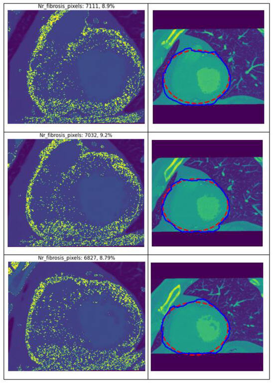Computer-Assisted Algorithm for Quantification of Fibrosis by Native ...