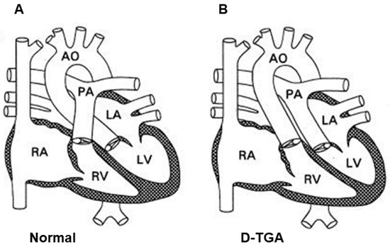 JCM | Free Full-Text | Pathogenesis and Surgical Treatment of Dextro ...