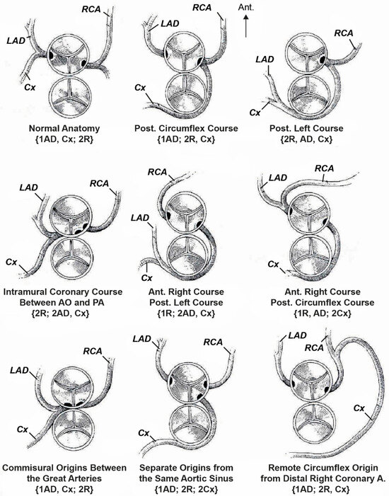 Pathogenesis and Surgical Treatment of Dextro-Transposition of the ...