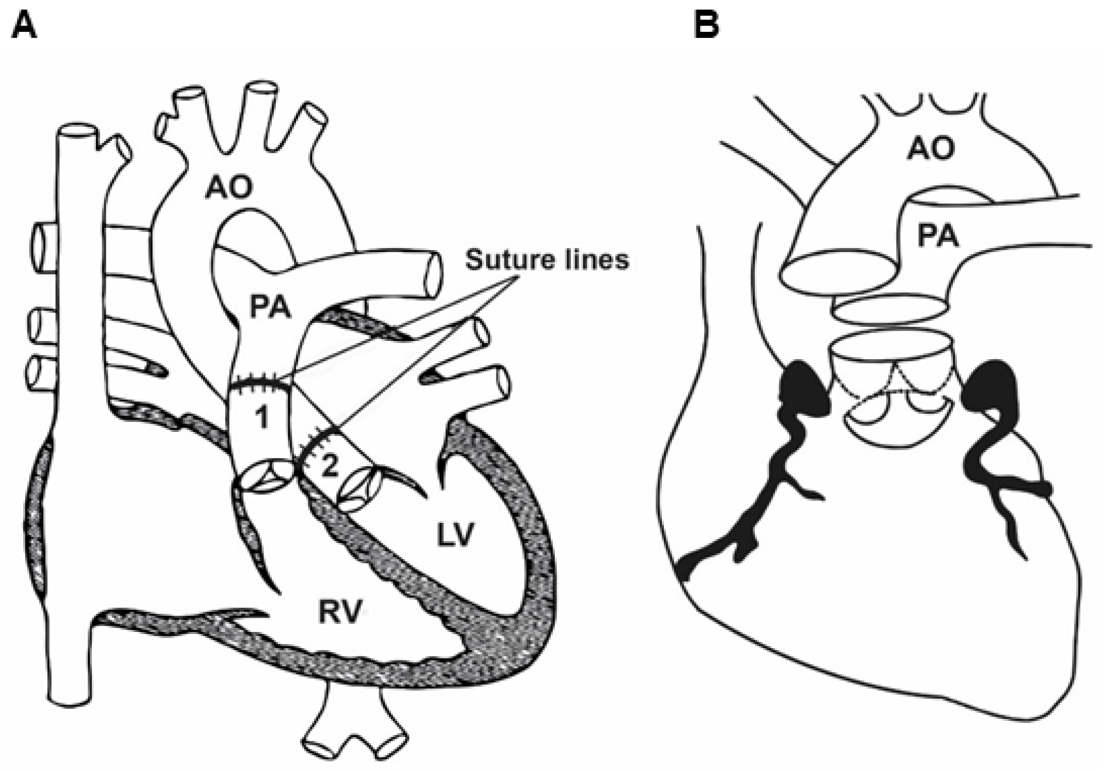 JCM | Free Full-Text | Pathogenesis and Surgical Treatment of Dextro ...