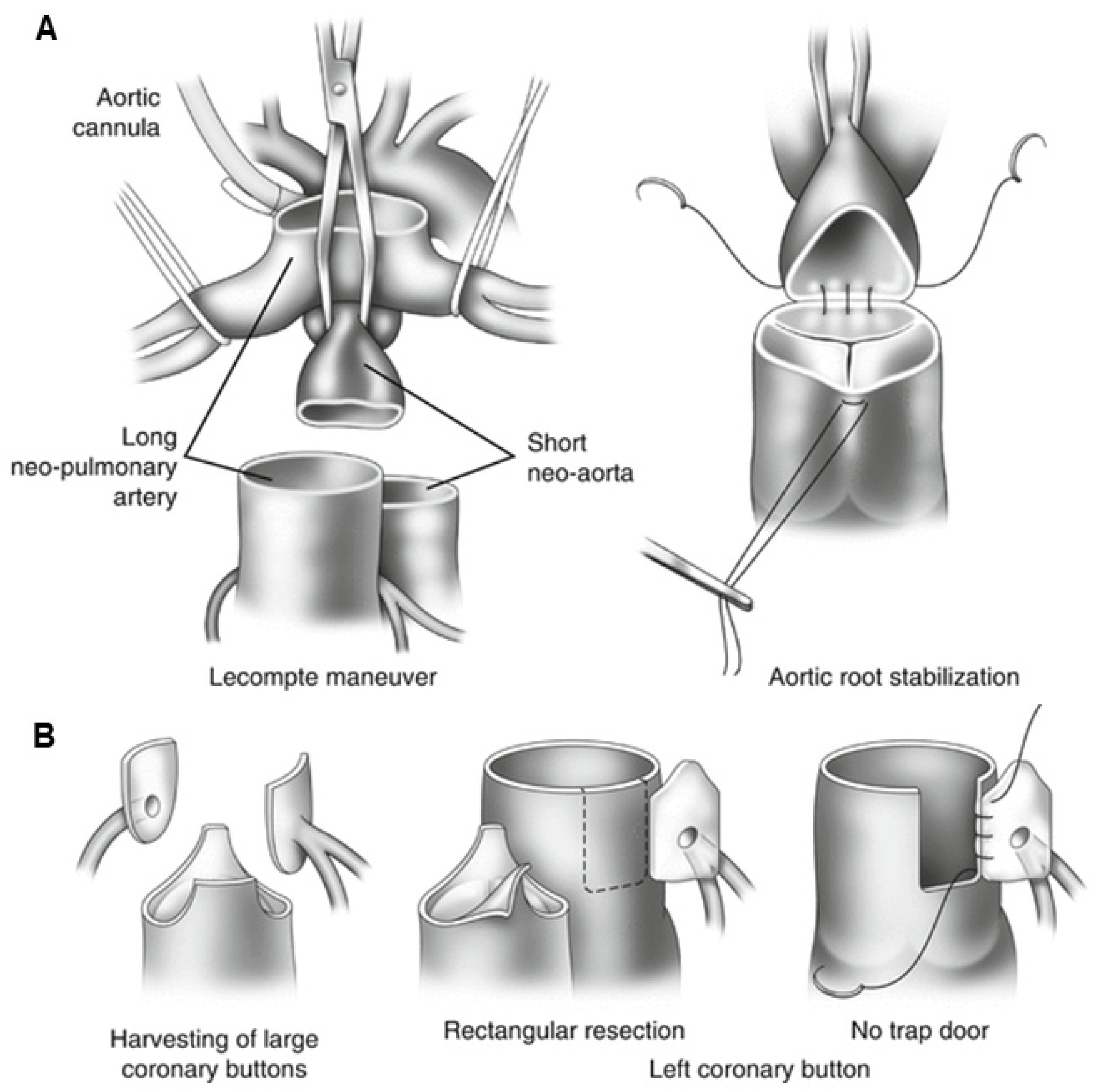 Pathogenesis and Surgical Treatment of Dextro-Transposition of the ...