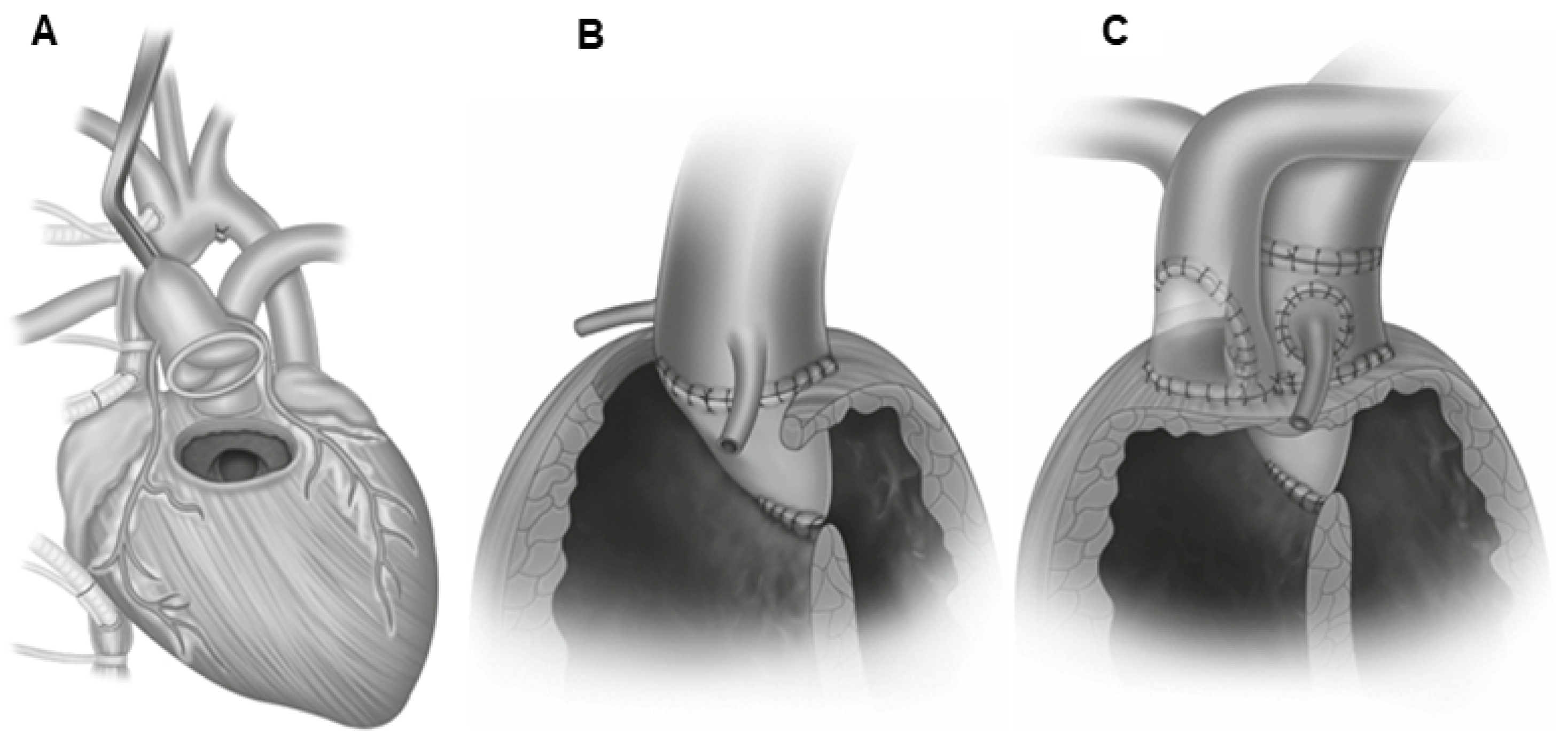 JCM | Free Full-Text | Pathogenesis and Surgical Treatment of Dextro ...