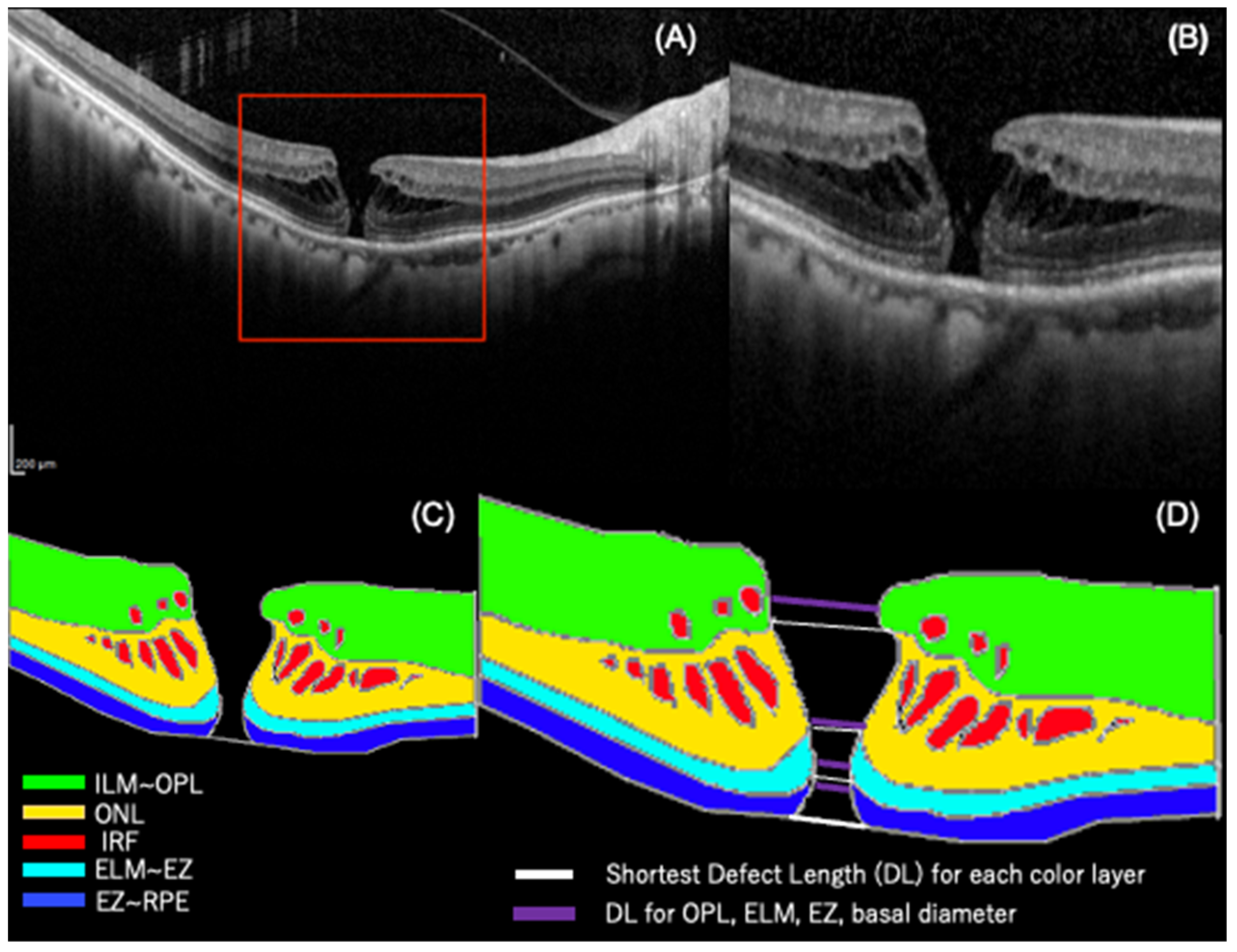 Preoperative OCT Characteristics Contributing to Prediction of ...
