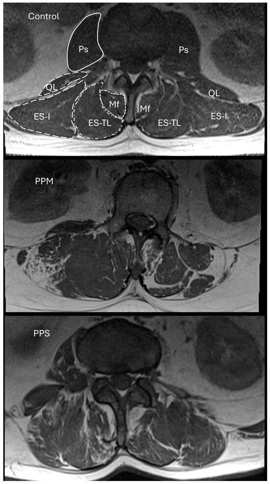 Differentiation of Post-Polio Syndrome from Prior Poliomyelitis Sequela ...