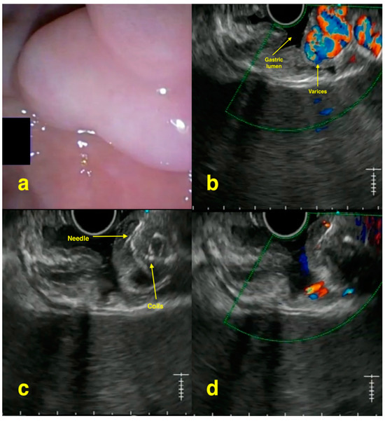 EUS-Guided Vascular Interventions: Recent Advances