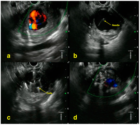 EUS-Guided Vascular Interventions: Recent Advances