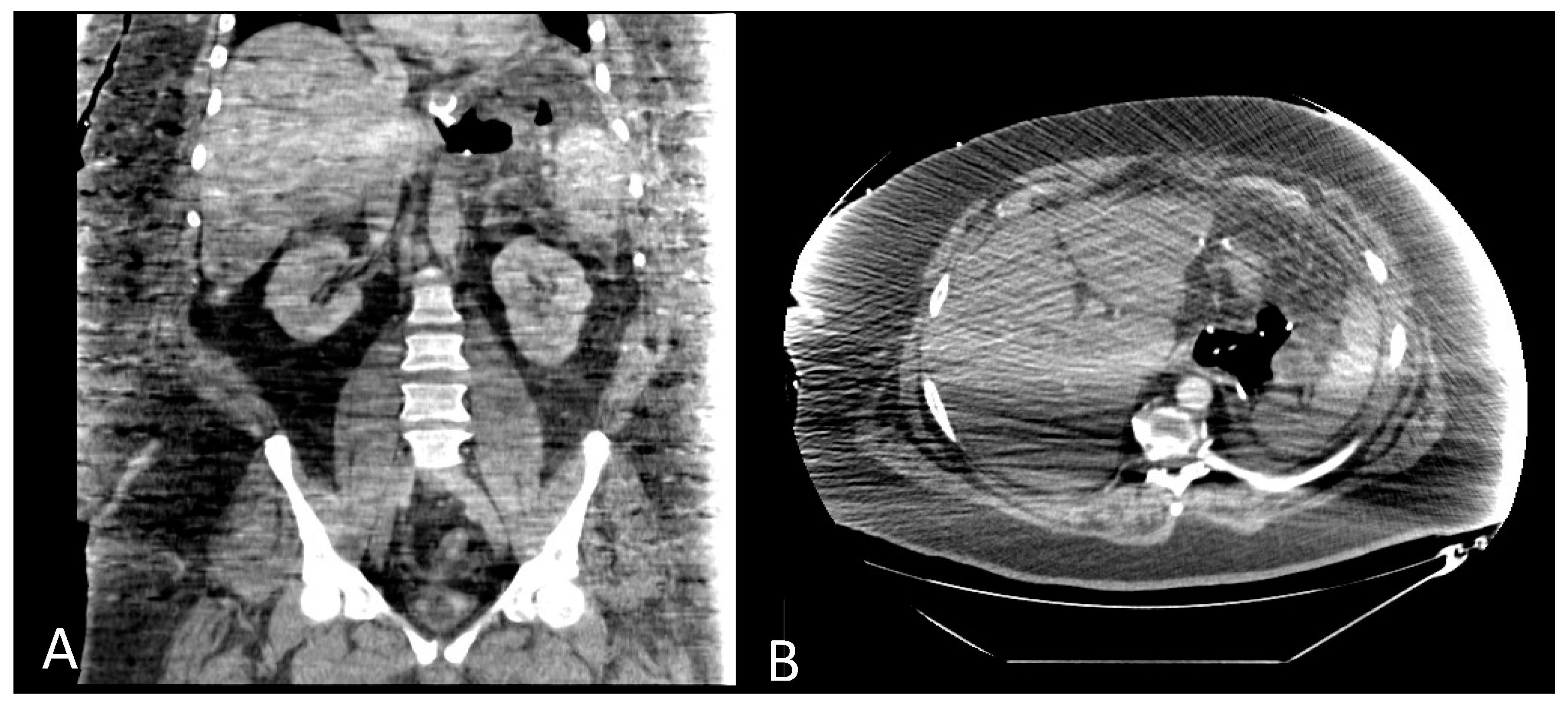 New Endoscopic Devices and Techniques for the Management of Post-Sleeve ...