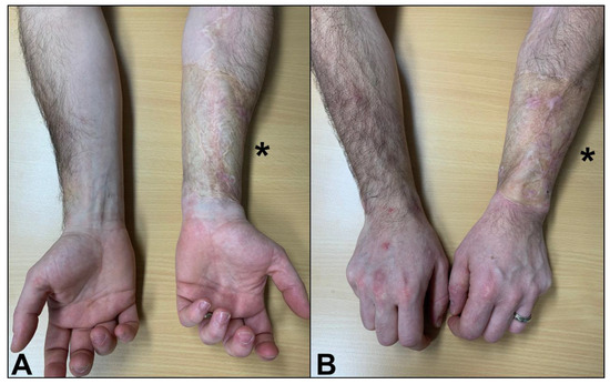 Shear Wave Elastography of the Skin following Radial Forearm Free Flap ...