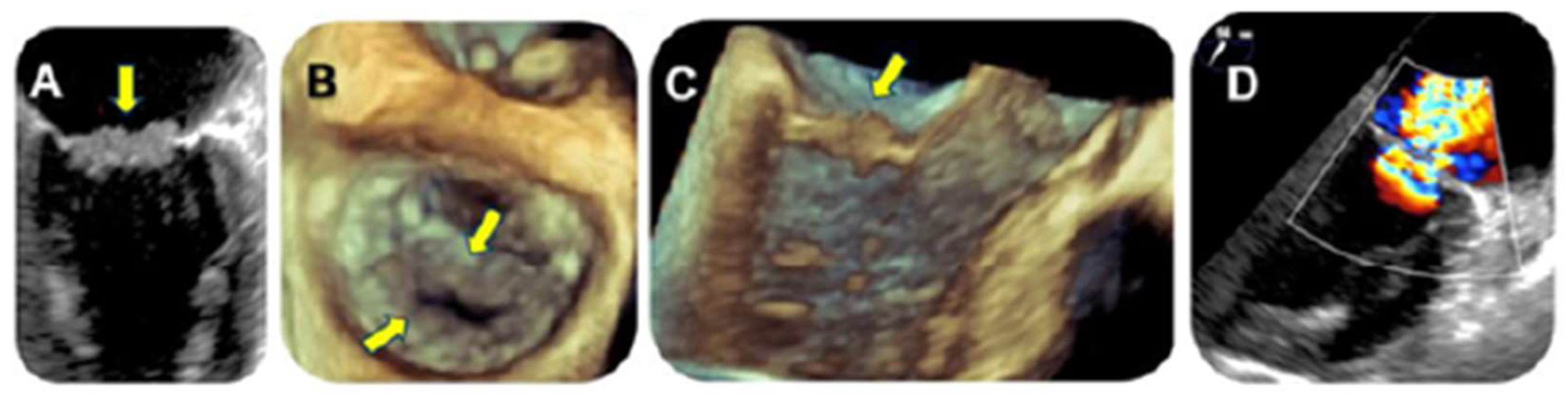 Exploring the Complexities of Non-Bacterial Thrombotic Endocarditis ...