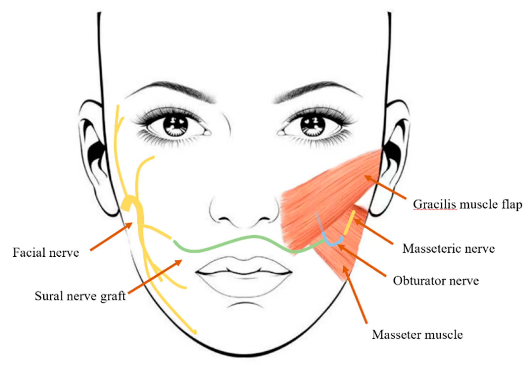Dynamic Repair Surgery for Late-Stage Facial Paralysis: Advances in ...