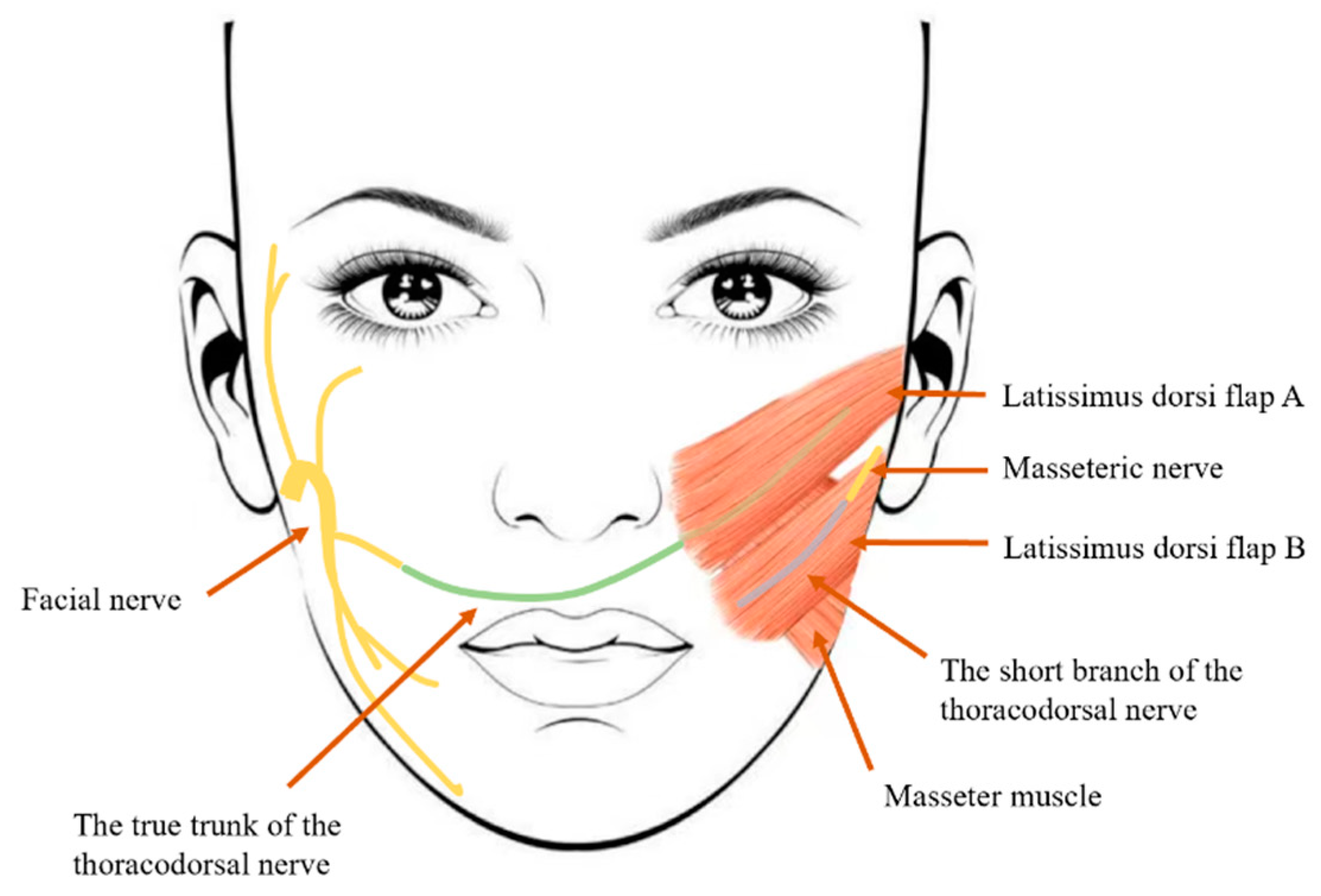 Dynamic Repair Surgery for Late-Stage Facial Paralysis: Advances in ...