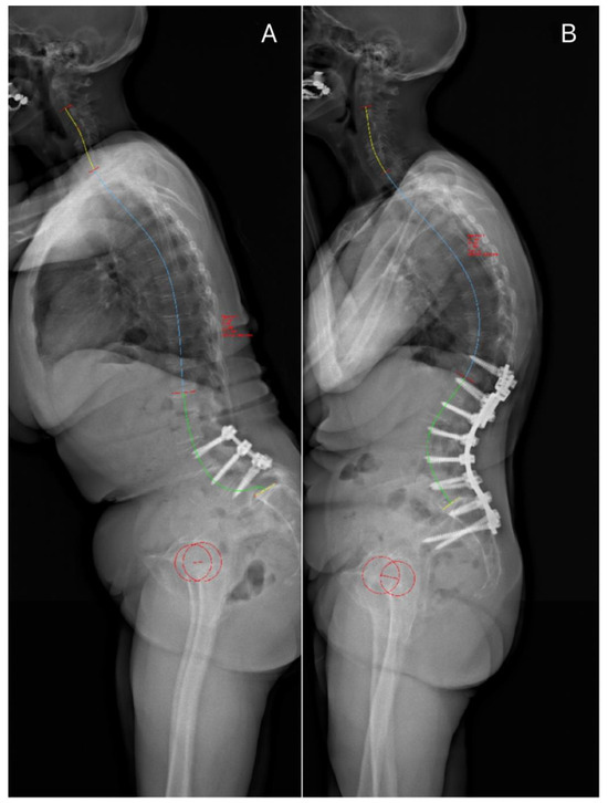 Distal Junctional Failure: A Feared Complication of Multilevel ...