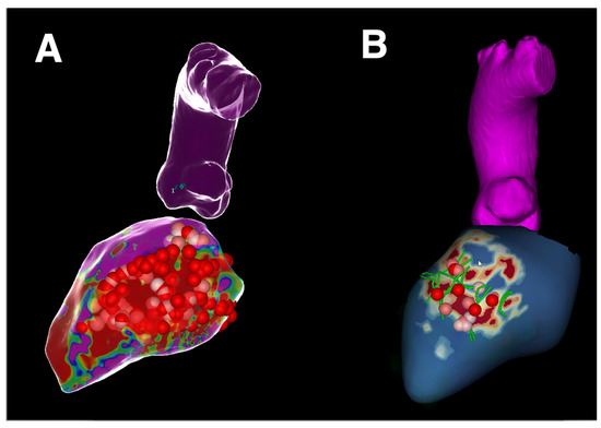 Approaching Ventricular Tachycardia Ablation in 2024: An Update on ...