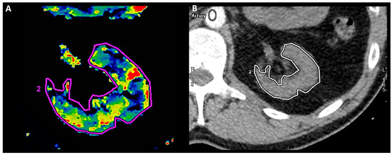 Absolute Stenosis Measures of Renal Artery Independently Influence ...