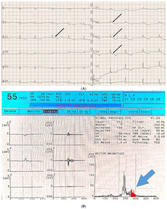 JCM | Free Full-Text | Correlation between Epsilon Wave and Late ...