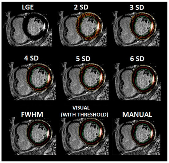 Myocardial Fibrosis Quantification Methods by Cardiovascular Magnetic ...