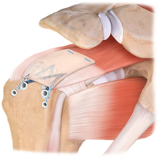 Patch Augmentation in Arthroscopic Rotator Cuff Surgery—Review of ...
