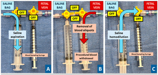 Treatment of Twin Anemia Polycythemia Sequence with Donor Transfusion ...