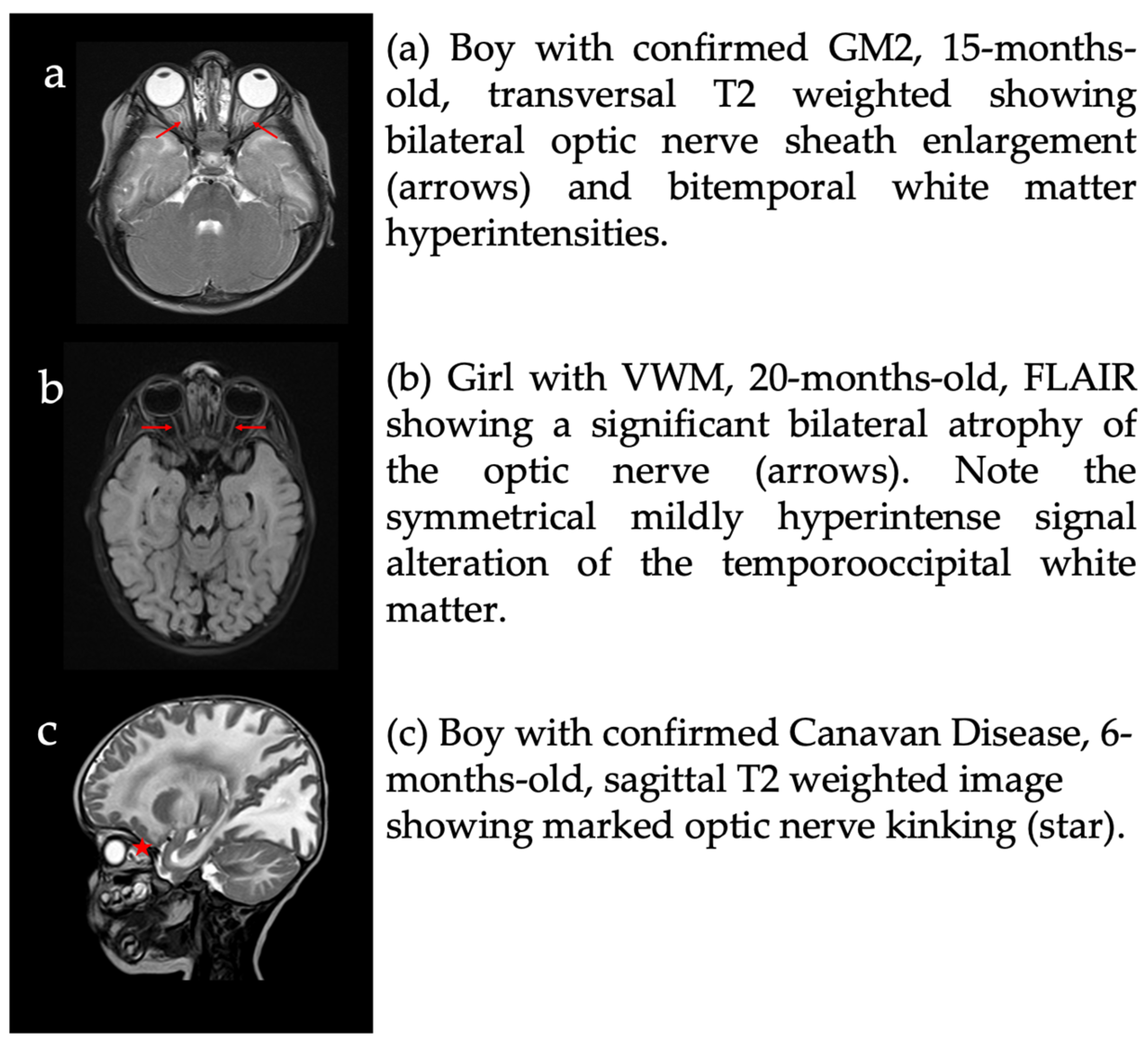 Overview of Neuro-Ophthalmic Findings in Leukodystrophies
