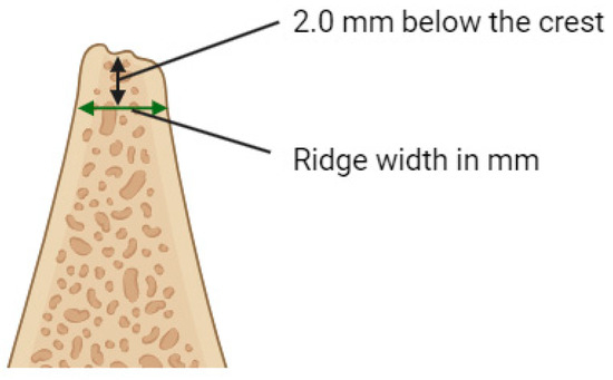 JCM | Free Full-Text | Lateral Alveolar Ridge Augmentation with ...