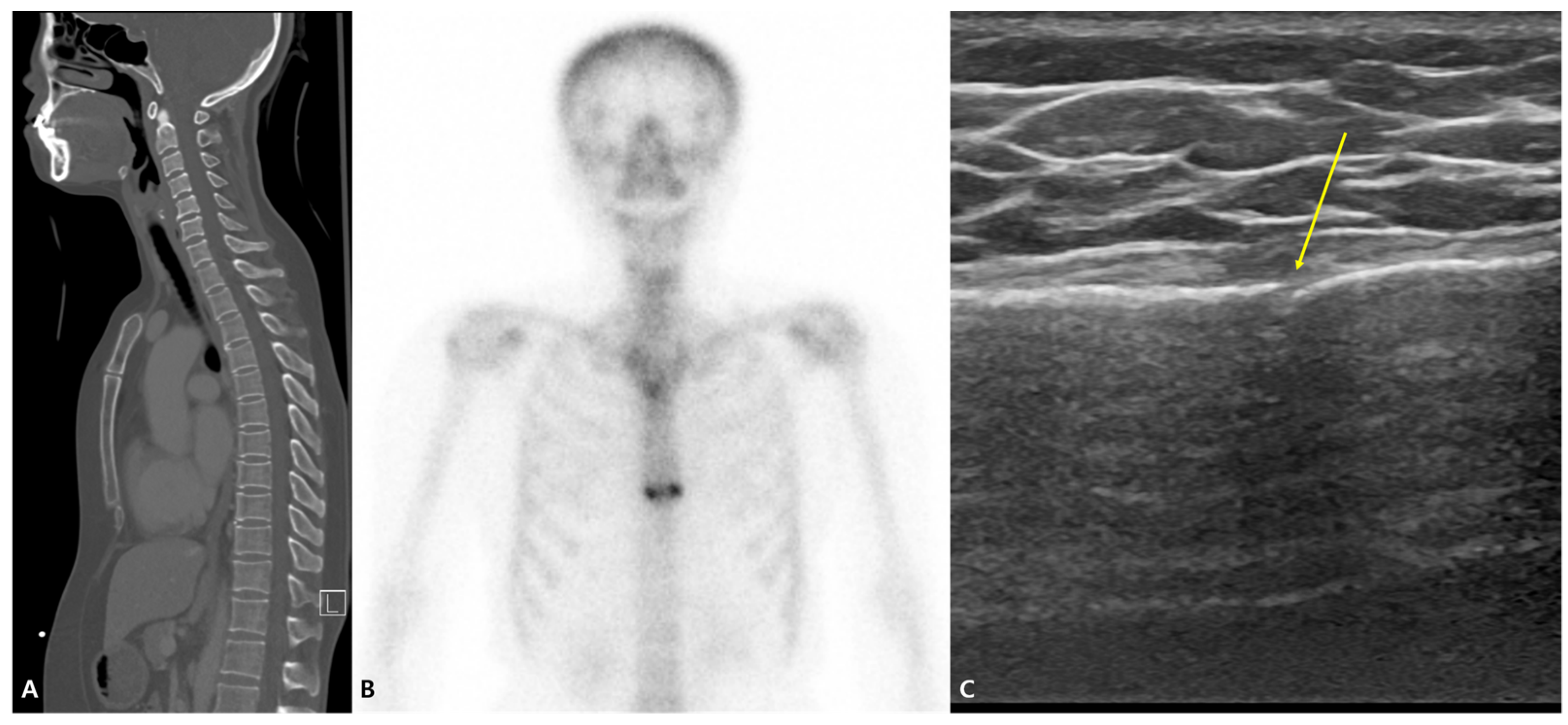 Diagnostic Value of Ultrasound for Sternal Fractures in Patients with ...