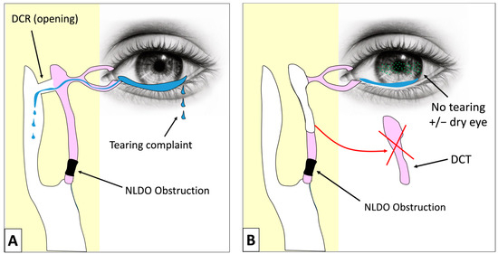 Dacryocystitis: Is Dacryocystorhinostomy Always the Solution?