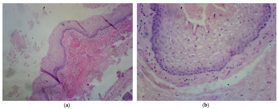 Two Cases of Symptomatic Tailgut Cysts