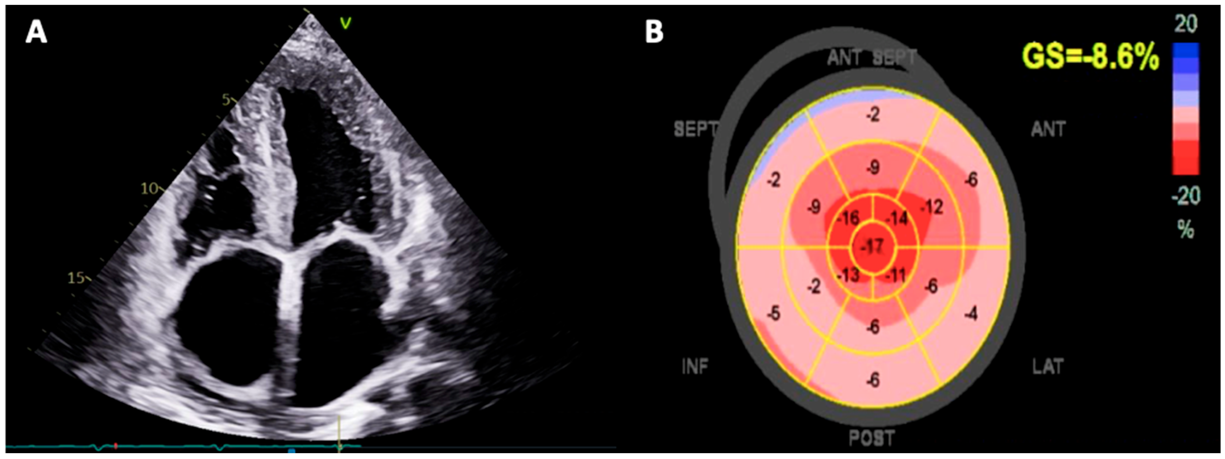 Epidemiological Changes in Transthyretin Cardiac Amyloidosis: Evidence ...