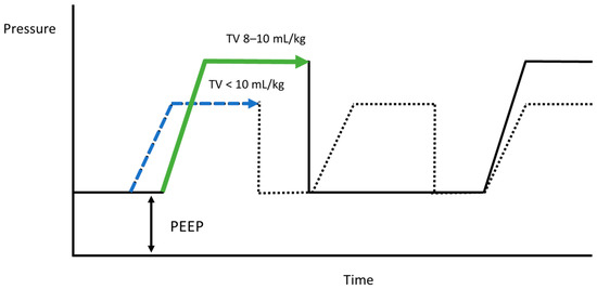 Impact of Ventilator Settings on Pulmonary Nodule Localization Accuracy ...