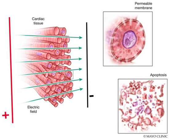 Pulsed Field Ablation: A Comprehensive Update