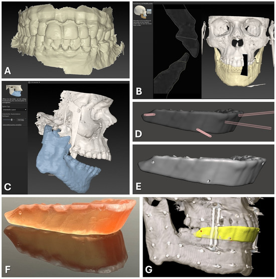 Intraoral Scanning Enables Virtual-Splint-Based Non-Invasive ...