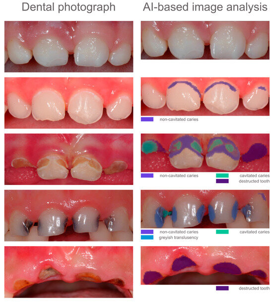 Validation of an Artificial Intelligence-Based Model for Early Childhood Caries Detection in ...